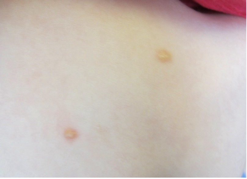 An Atlas of Lumps and Bumps, Part 49: Solitary Cutaneous Mastocytoma | Consultant360